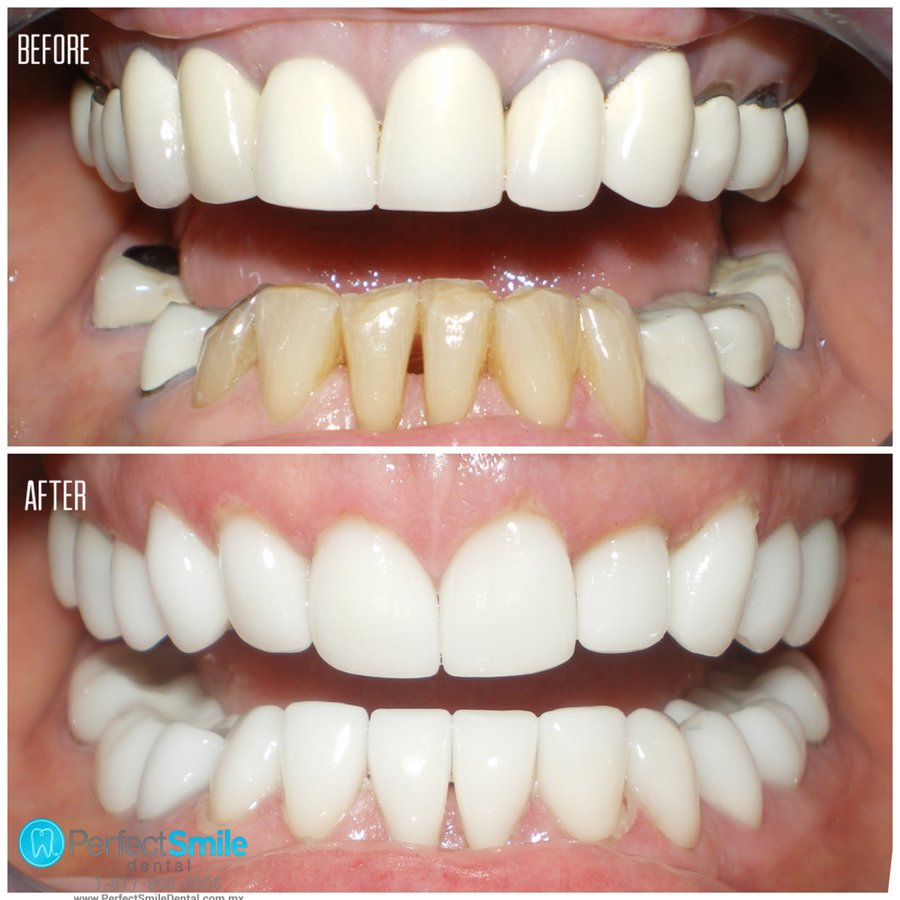 Perfect Smile Dental Implant Center